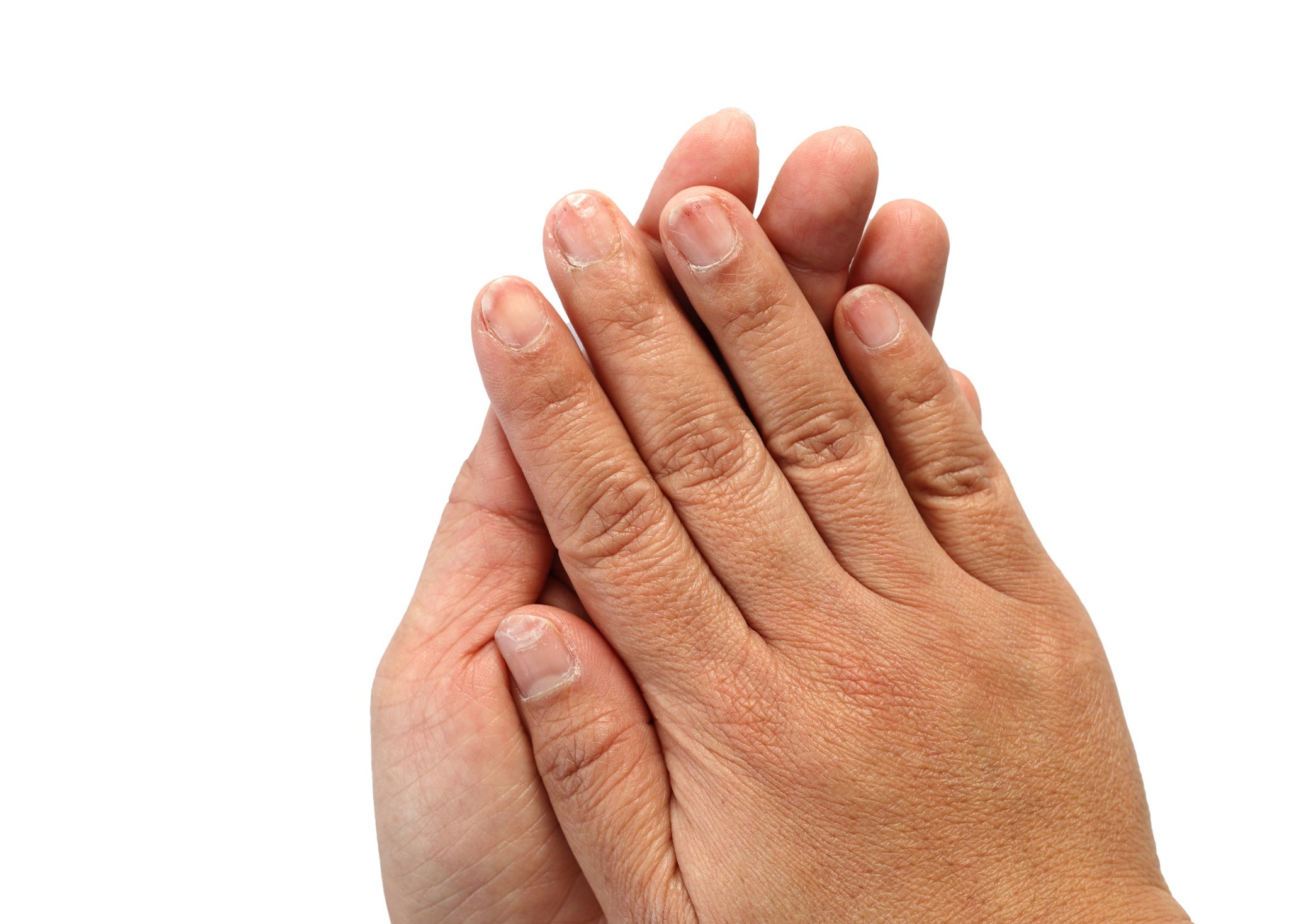 Motivos por los que se rompen las uñas | CEM Canarias